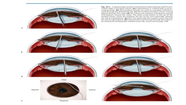 Minimally invasive Glaucoma surgery MIGS | PPT