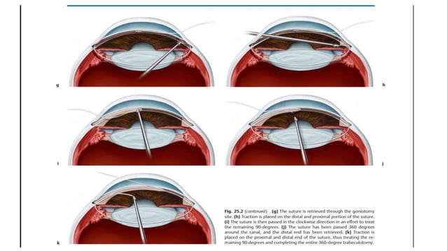 Minimally invasive Glaucoma surgery MIGS | PPTX | Eye and Vision ...