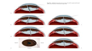 Minimally invasive Glaucoma surgery MIGS | PPTX