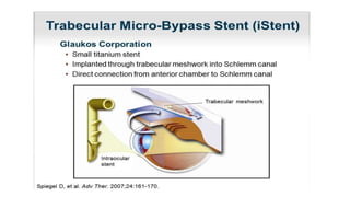 Minimally invasive Glaucoma surgery MIGS | PPTX