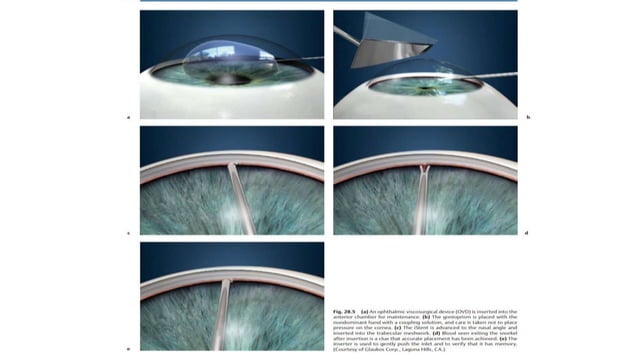 Minimally invasive Glaucoma surgery MIGS | PPTX | Eye and Vision ...