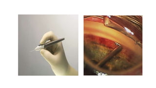 Minimally invasive Glaucoma surgery MIGS | PPTX