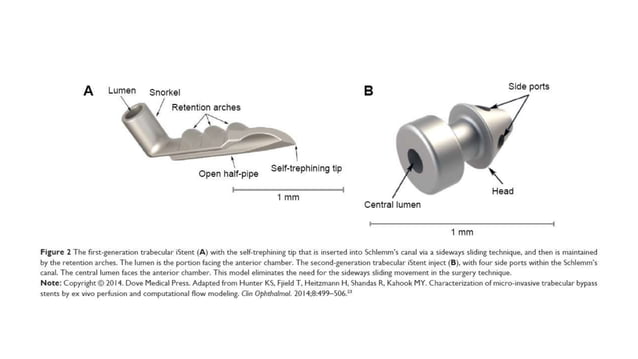 Minimally invasive Glaucoma surgery MIGS | PPT