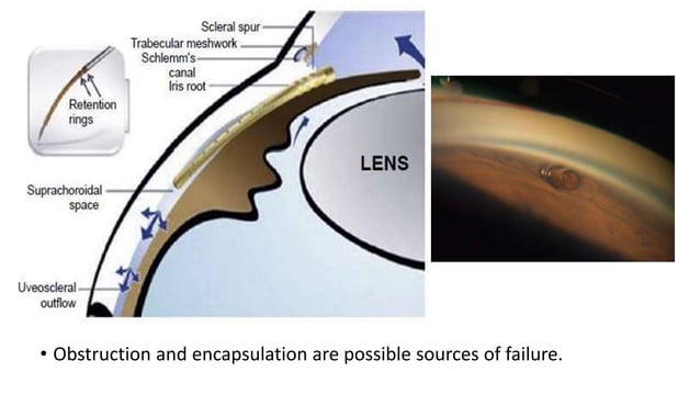 Minimally invasive Glaucoma surgery MIGS | PPTX | Eye and Vision ...