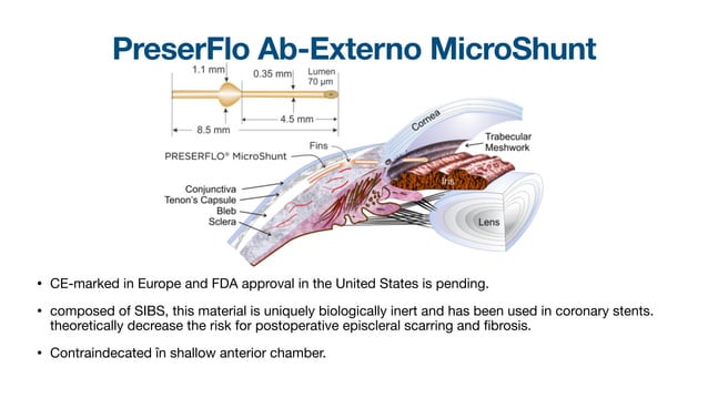 Microinvasive Glaucoma Surgery MIGS .pdf