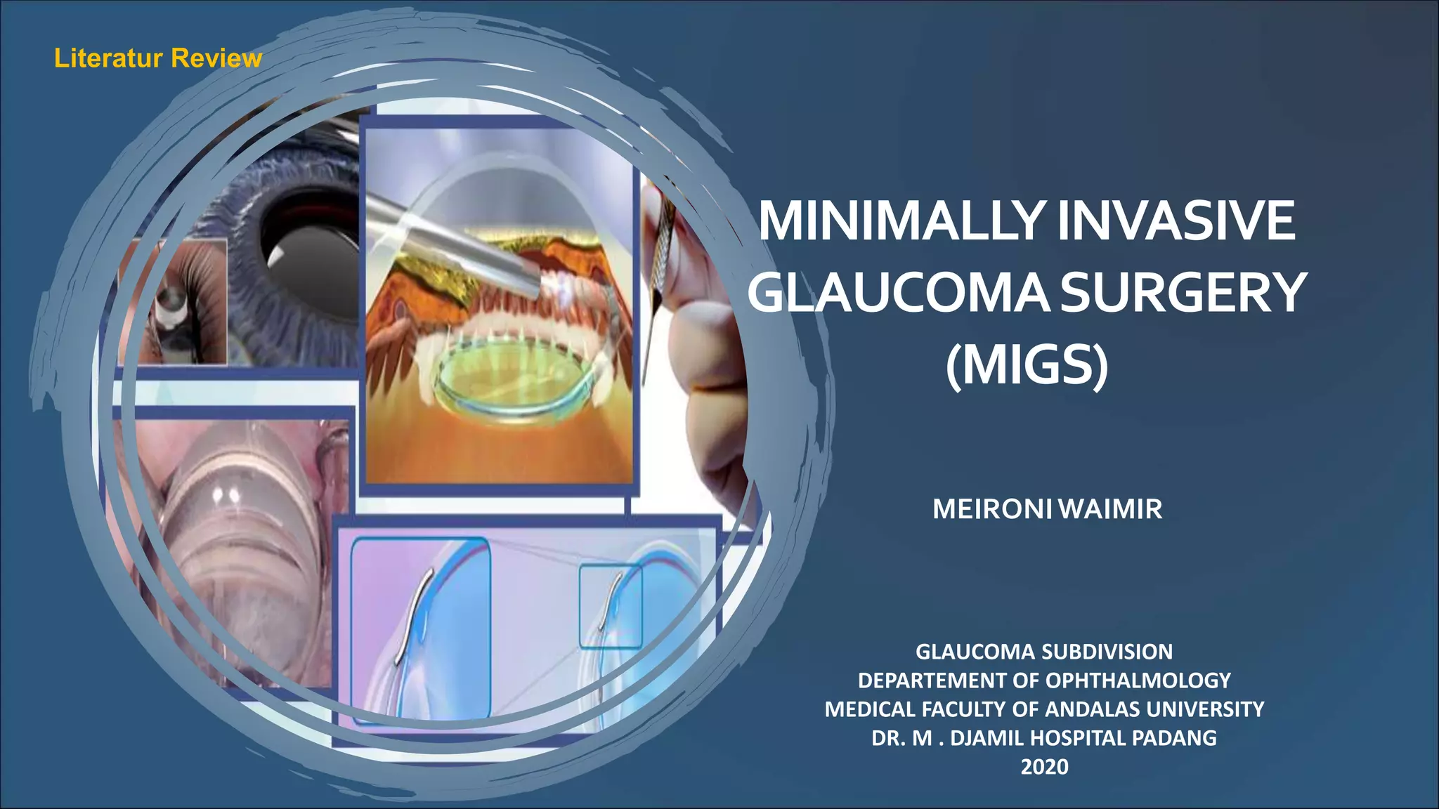 Minimally Invasive Glaucoma Surgery (MIGS) | PPT