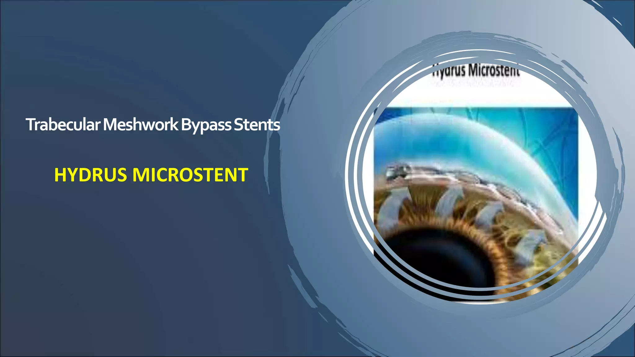 Minimally Invasive Glaucoma Surgery (MIGS) | PPT
