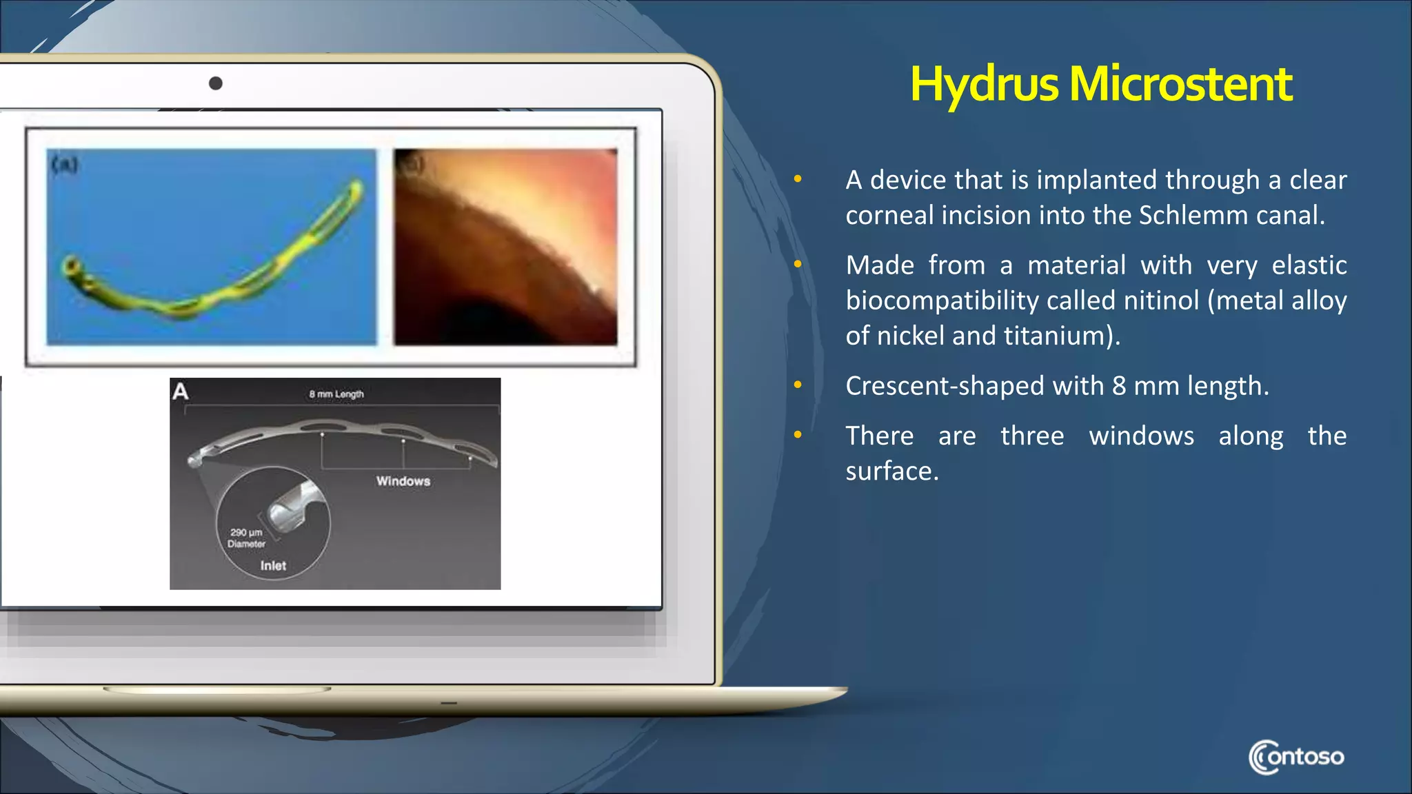 Minimally Invasive Glaucoma Surgery (MIGS) | PPT