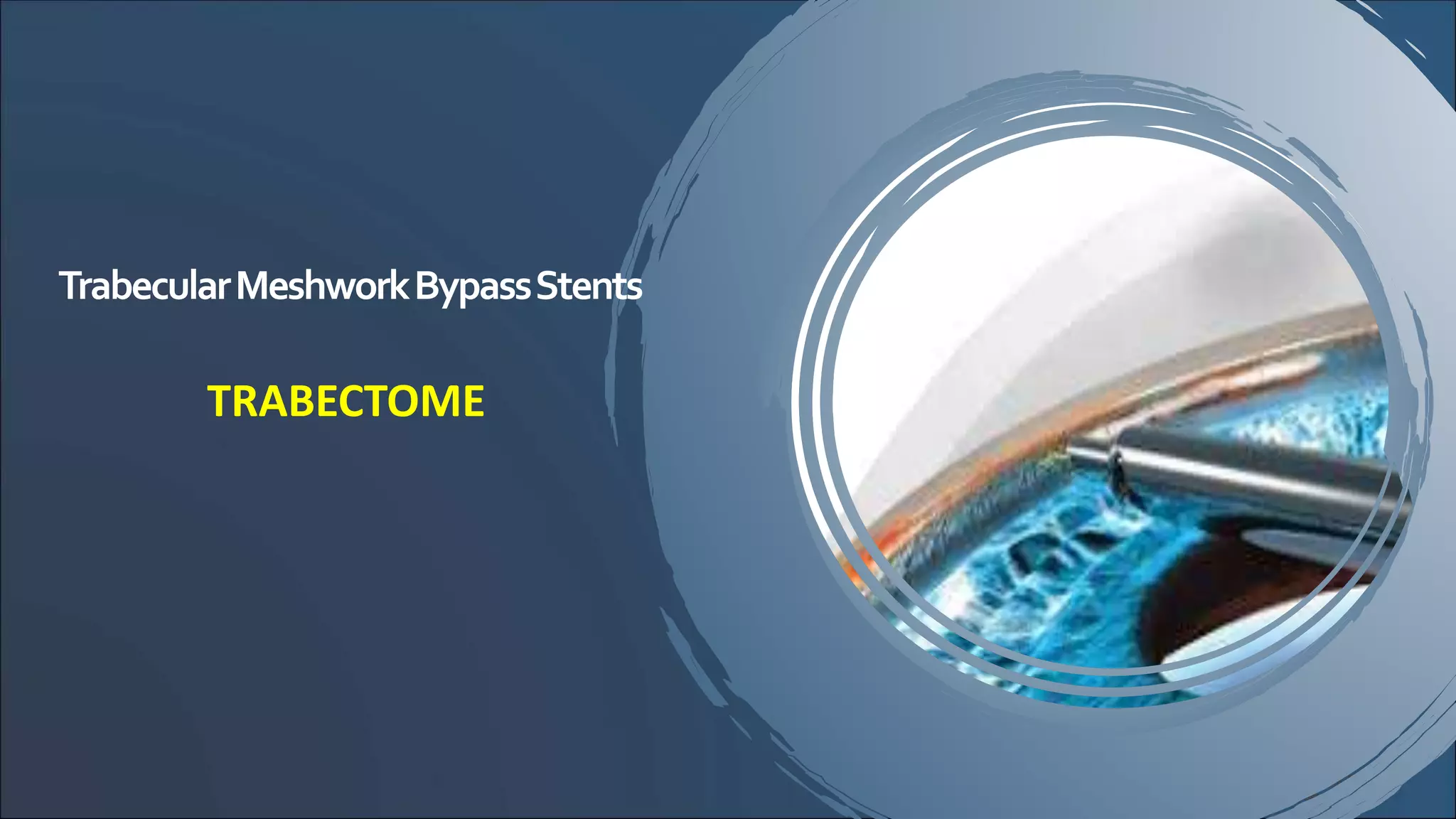 Minimally Invasive Glaucoma Surgery (MIGS) | PPT