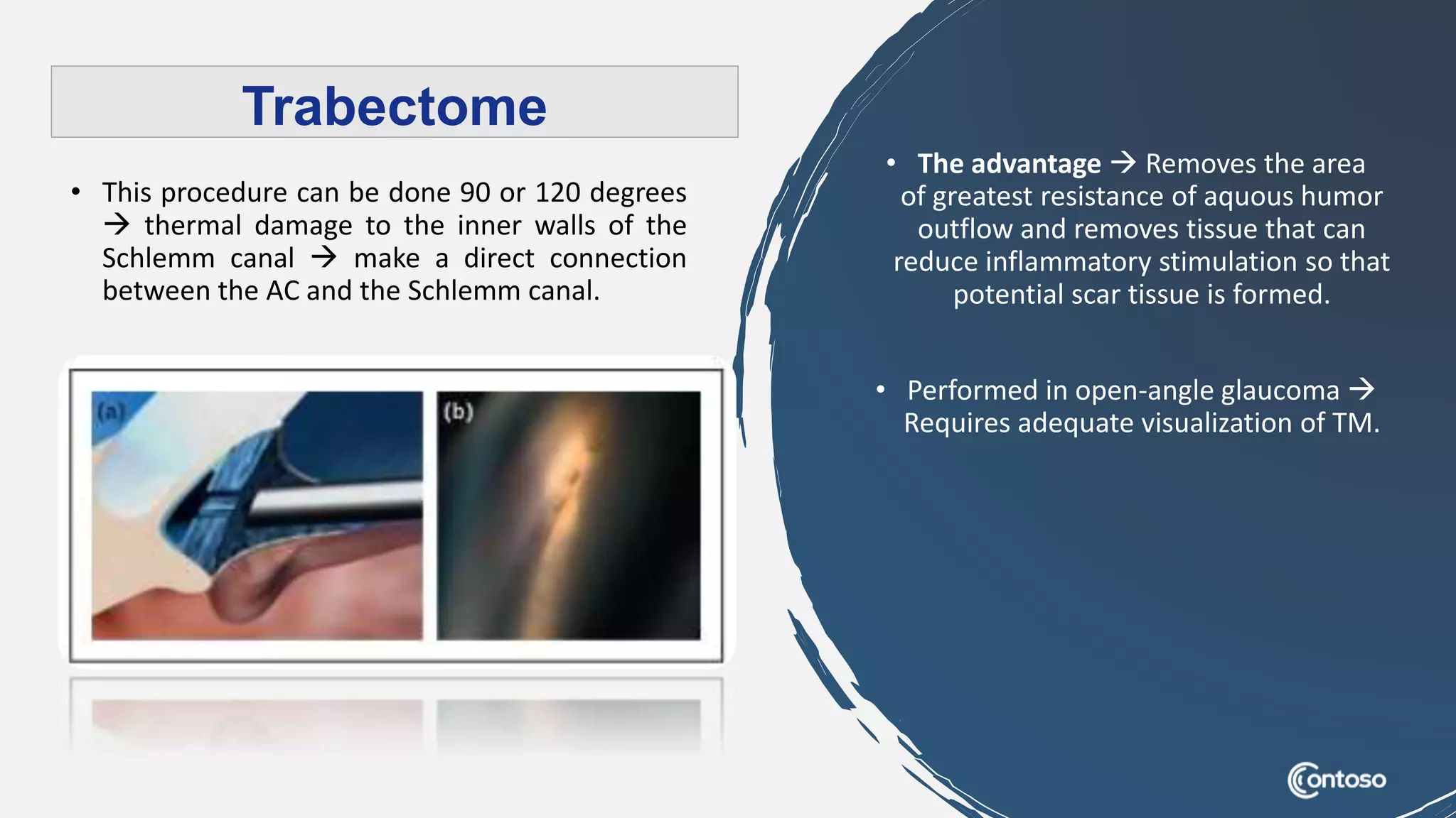 Minimally Invasive Glaucoma Surgery (MIGS) | PPT