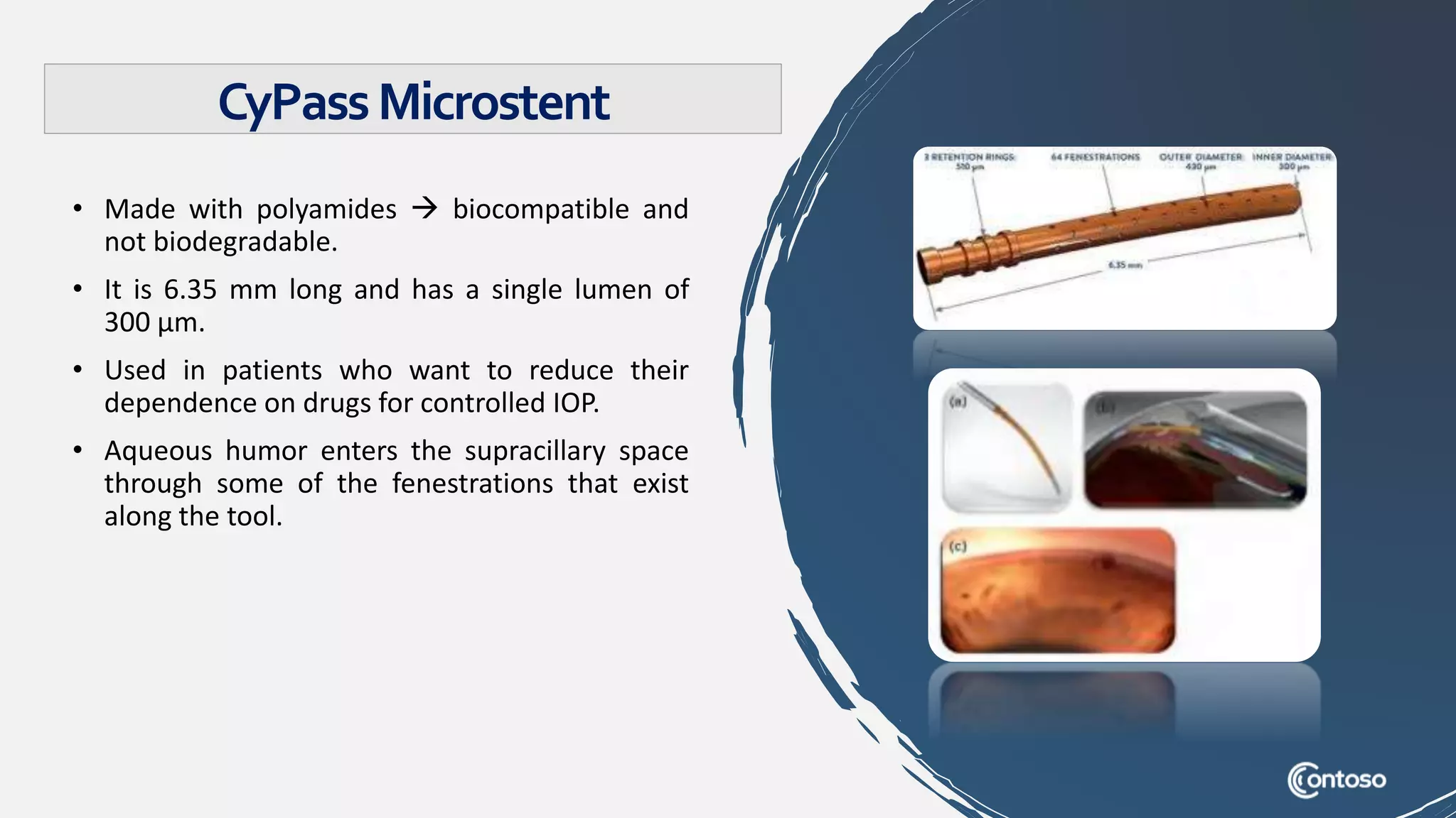 Minimally Invasive Glaucoma Surgery (MIGS) | PPT