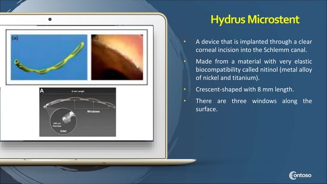 Minimally Invasive Glaucoma Surgery (MIGS) | PPT | Eye and Vision ...