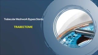 Minimally Invasive Glaucoma Surgery (MIGS) | PPT