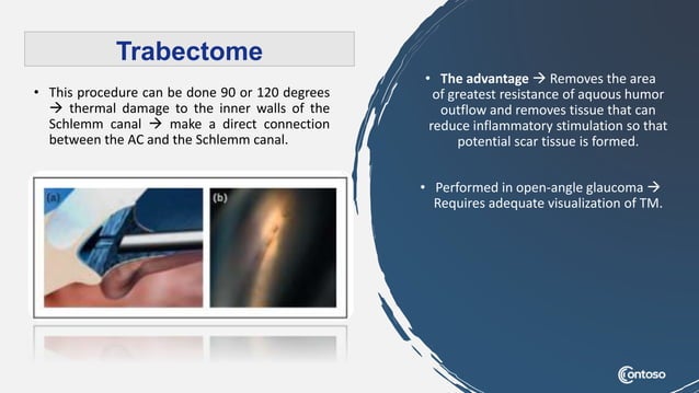 Minimally Invasive Glaucoma Surgery Migs Ppt Eye And Vision