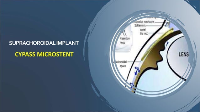 Minimally Invasive Glaucoma Surgery (MIGS) | PPT | Eye and Vision ...
