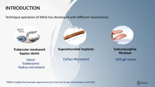 Minimally Invasive Glaucoma Surgery (MIGS) | PPT