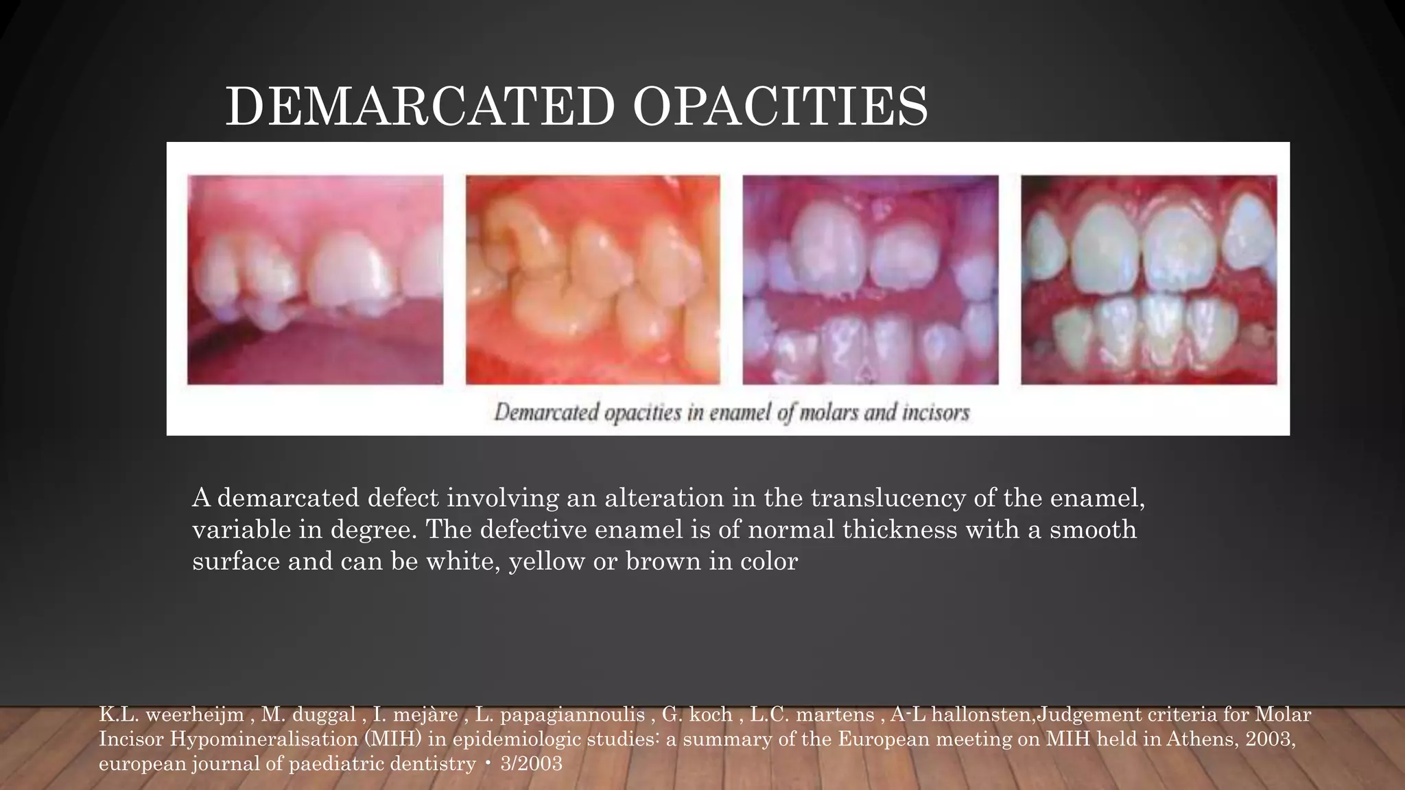 MOLAR INCISOR HYPOMINERALIZATION | PPTX