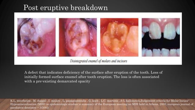 MOLAR INCISOR HYPOMINERALIZATION | PPT