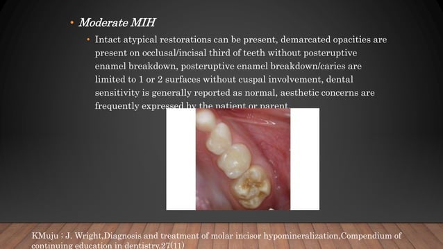 MOLAR INCISOR HYPOMINERALIZATION | PPT