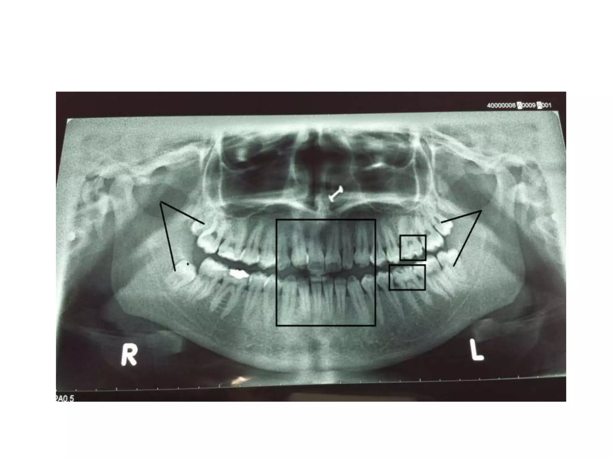 Molar incisor hypoplasia- dr arsalan | PPTX