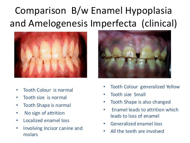 Molar incisor hypoplasia- dr arsalan