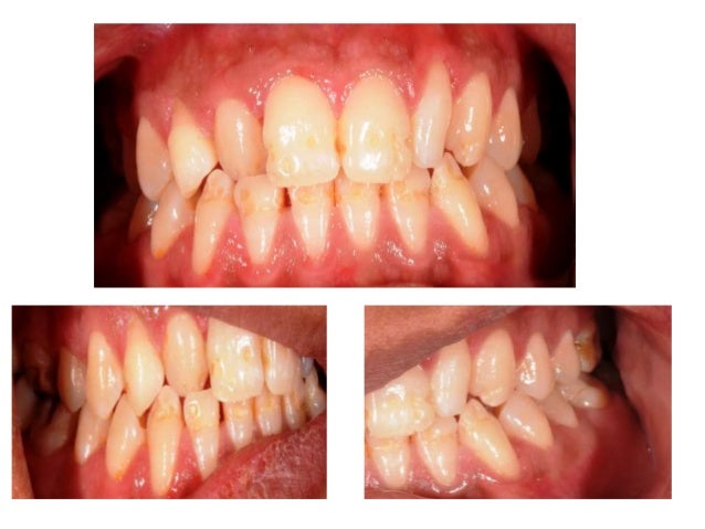 Molar incisor hypoplasia- dr arsalan