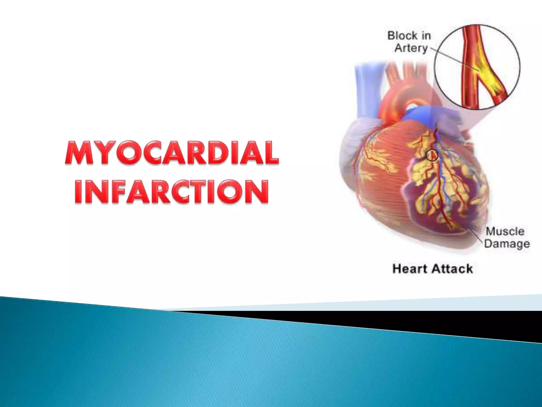 Myocardial Infarction | PPTX