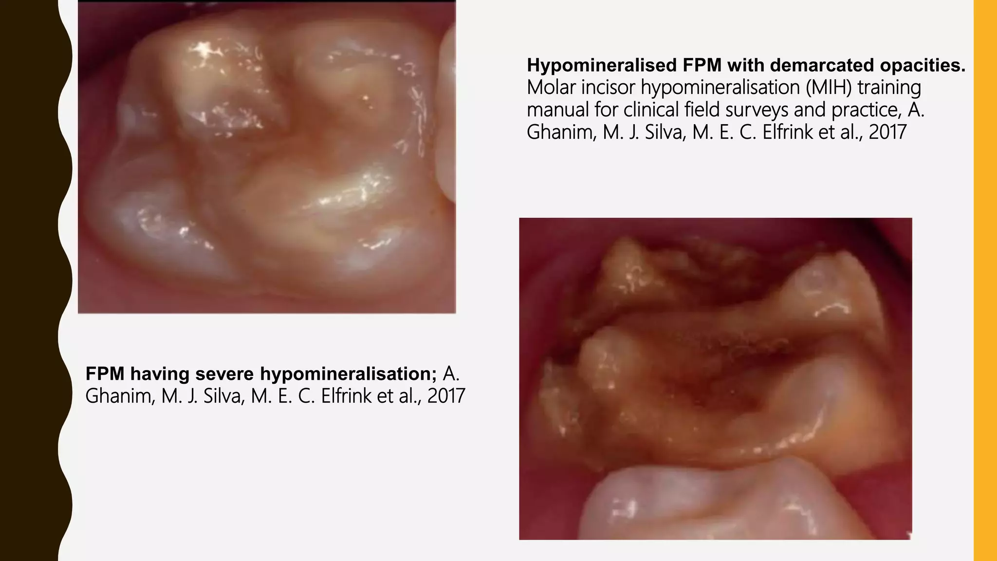 Molar incisor hypomineralisation pedodontics | PPTX