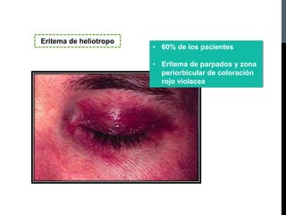 Miopatías inflamatorias idiopáticas (dematomiositis y polimiositis) | PPTX
