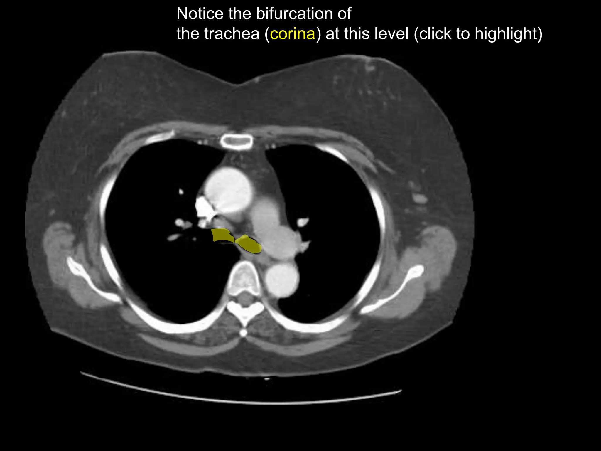Mike's CT Chest tests, ct scan education | PPT