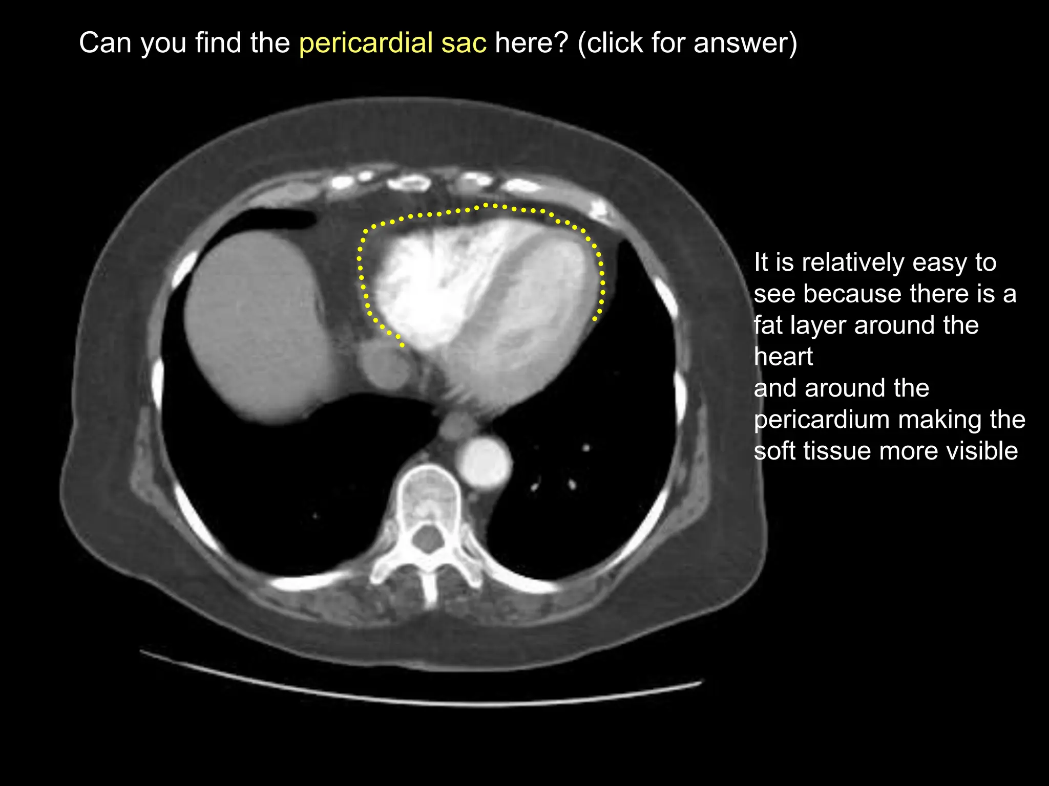 Mike's CT Chest tests, ct scan education | PPT