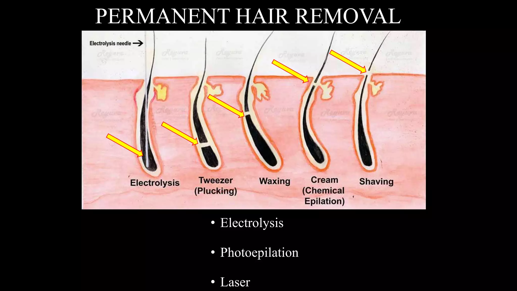 Milady hair removal ch 22 | PPTX