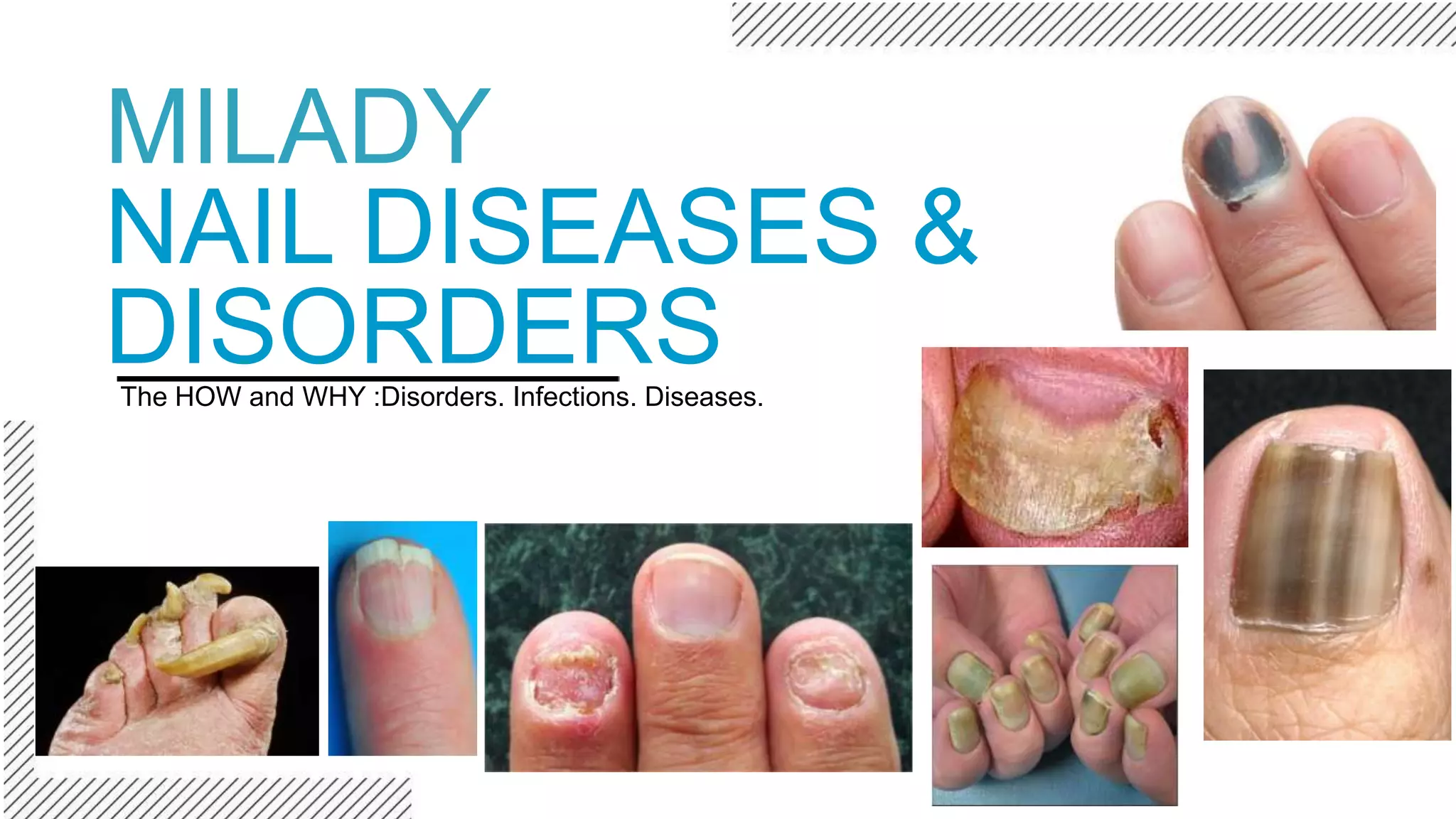 Milady nail disease & disorder | PPTX