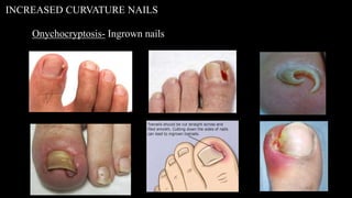 Milady nail disease & disorder | PPTX