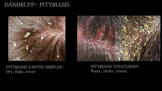 Pityriasis Steatoides Pixtures