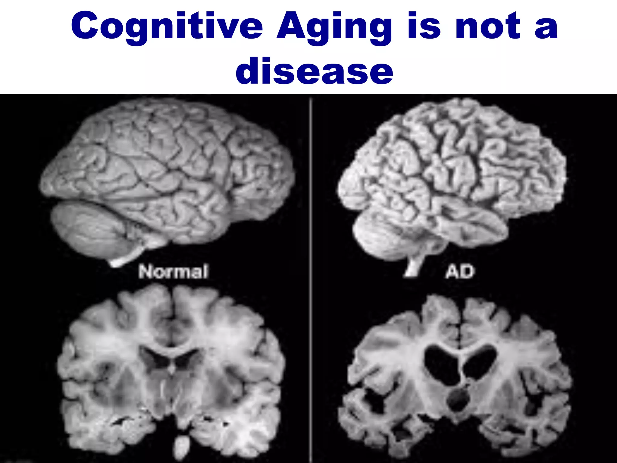 Mild cognitive impairment | PDF