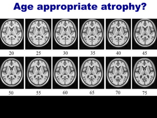 Mild cognitive impairment | PDF