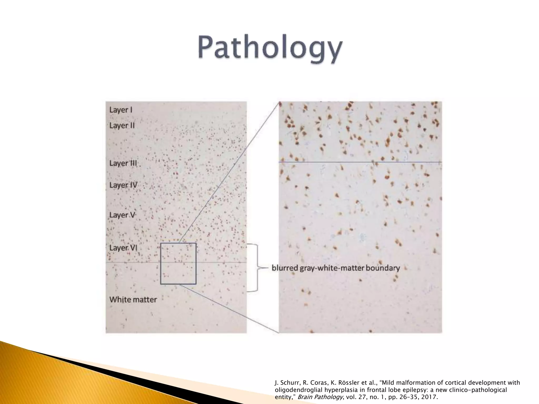 Mild Malformation of Cortical Development with Oligodendroglial ...