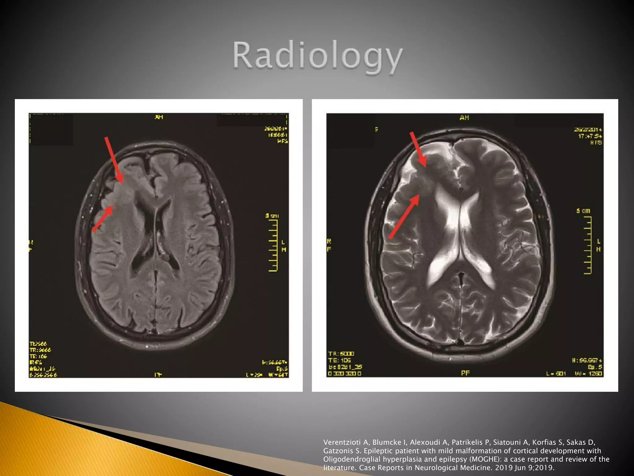 Mild Malformation of Cortical Development with Oligodendroglial ...