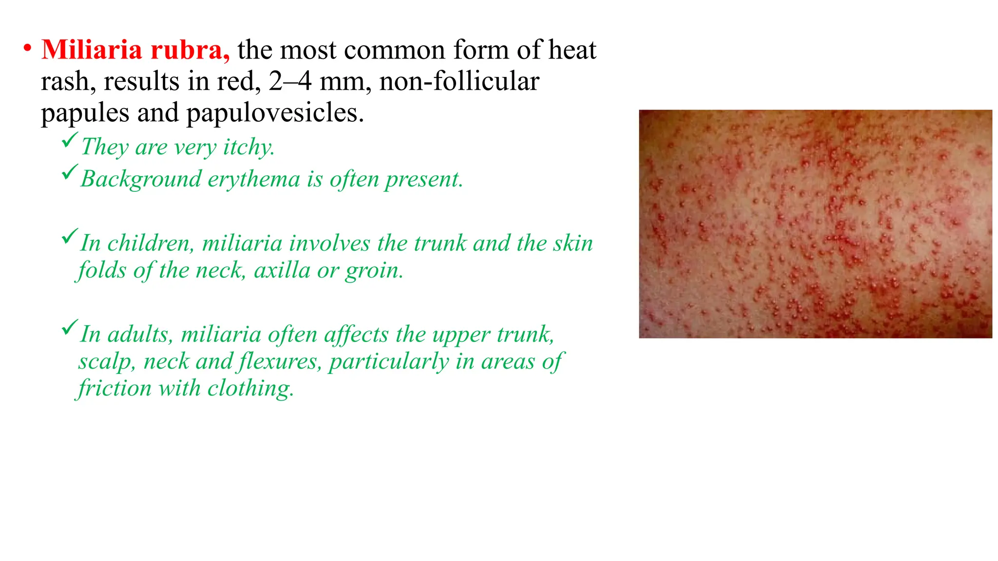 Miliaria(heat rash) - obstruction of sweat glands pptx | PPTX