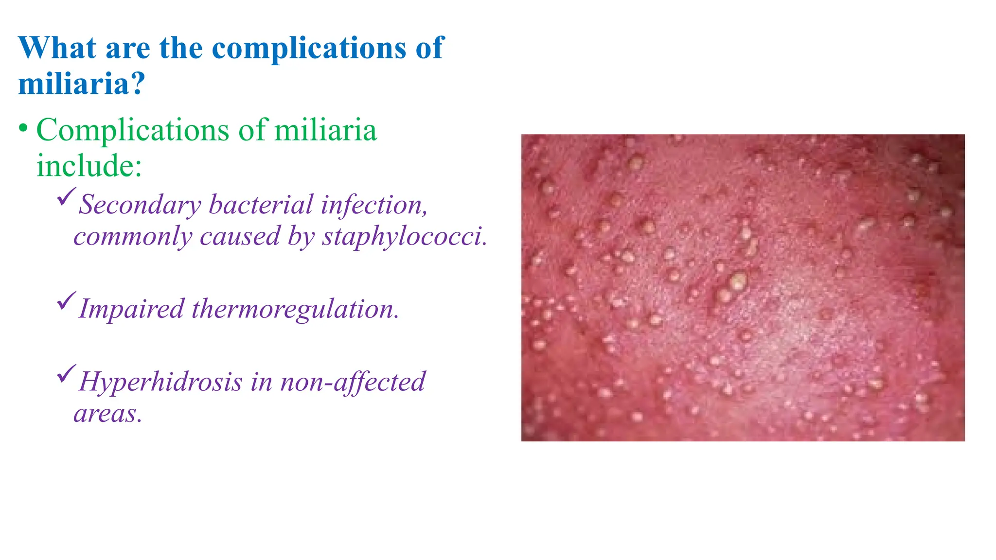 Miliaria(heat rash) - obstruction of sweat glands pptx | PPTX
