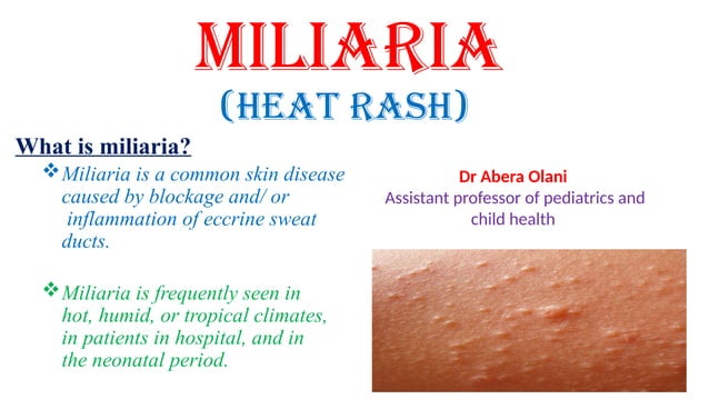 Miliaria(heat rash) - obstruction of sweat glands pptx | PPTX | Skin ...