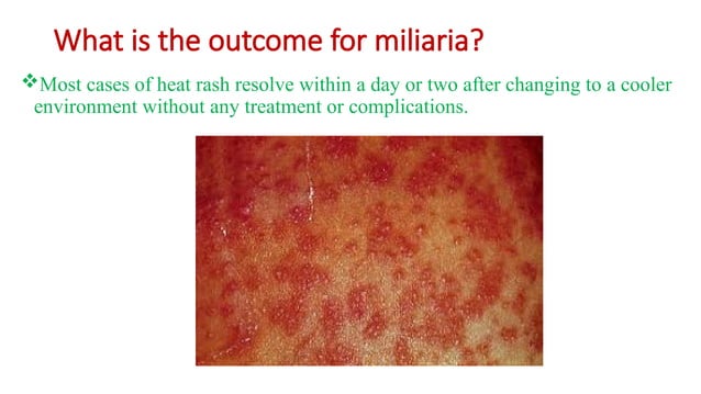 Miliaria(heat rash) - obstruction of sweat glands pptx | PPTX | Skin ...