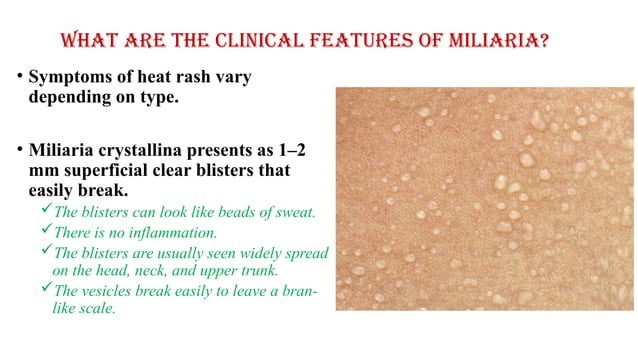 Miliaria(heat rash) - obstruction of sweat glands pptx | PPTX | Skin ...