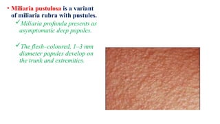 Miliaria(heat rash) - obstruction of sweat glands pptx | PPTX