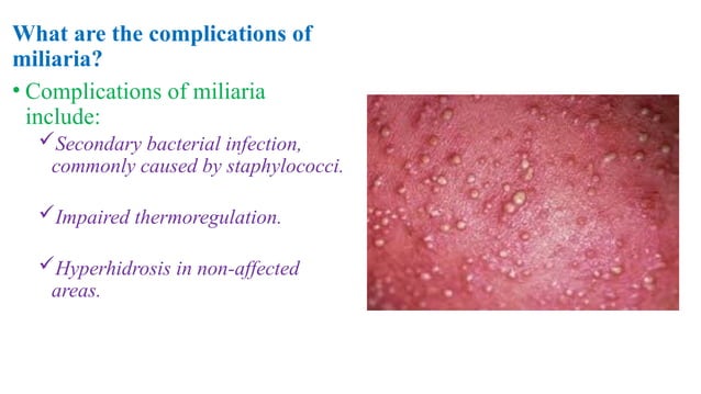 Miliaria(heat rash) - obstruction of sweat glands pptx | PPTX | Skin ...