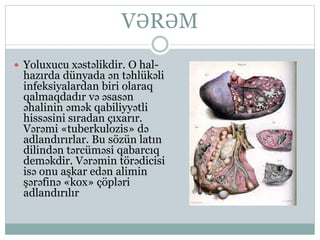 Miliar vərəm | PPTX
