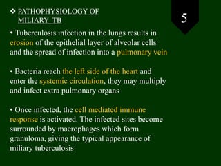 Miliary tuberculosis | PPTX
