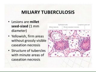Miliary Tuberculosis Histology