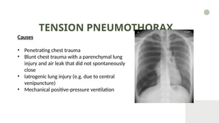 The presentation on the topic Chest Injury | PPTX
